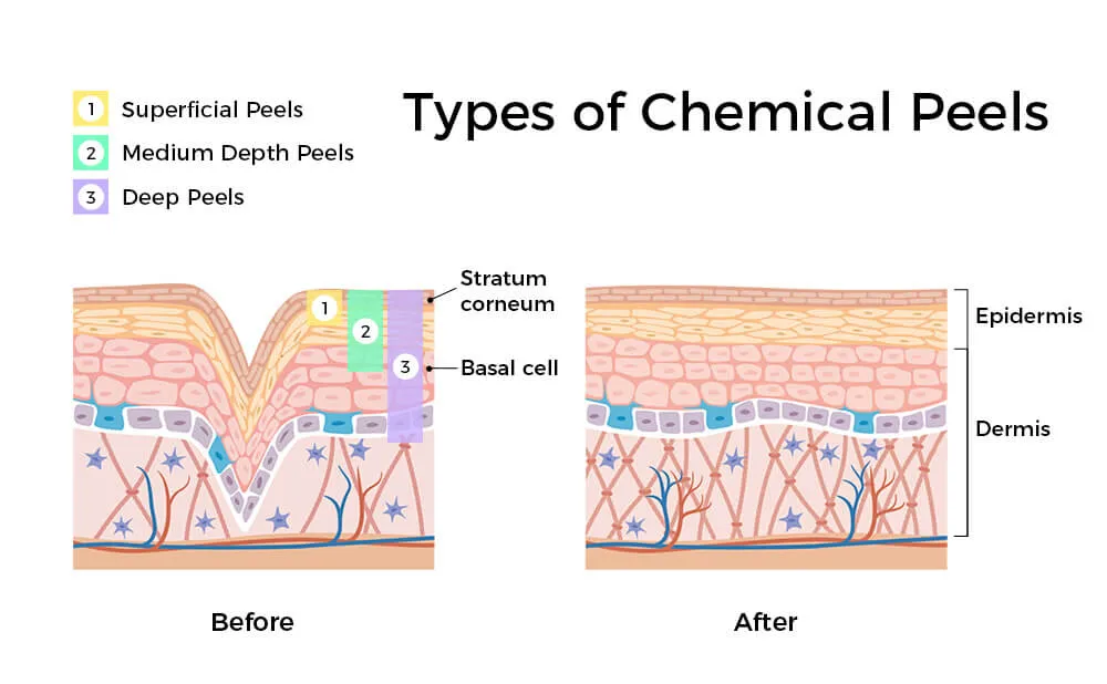 Can Estheticians Do Chemical Peels? All You Need To Know